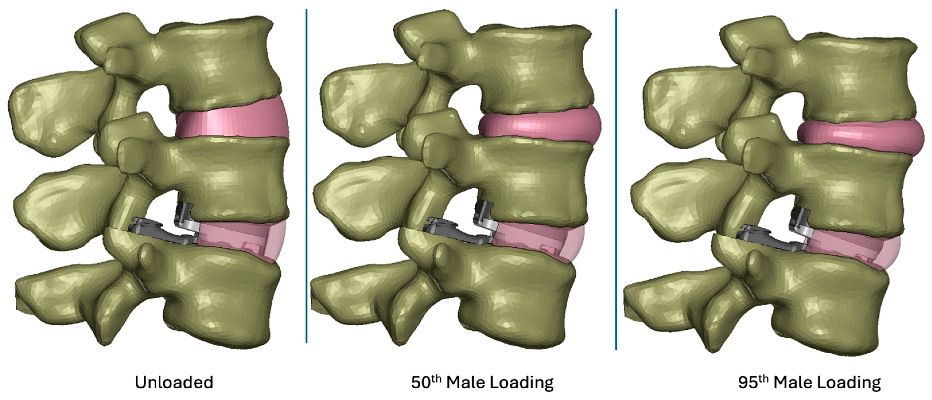 Polyethylene Stresses in Lumbar Total Joint Replacement Under Elevated ...