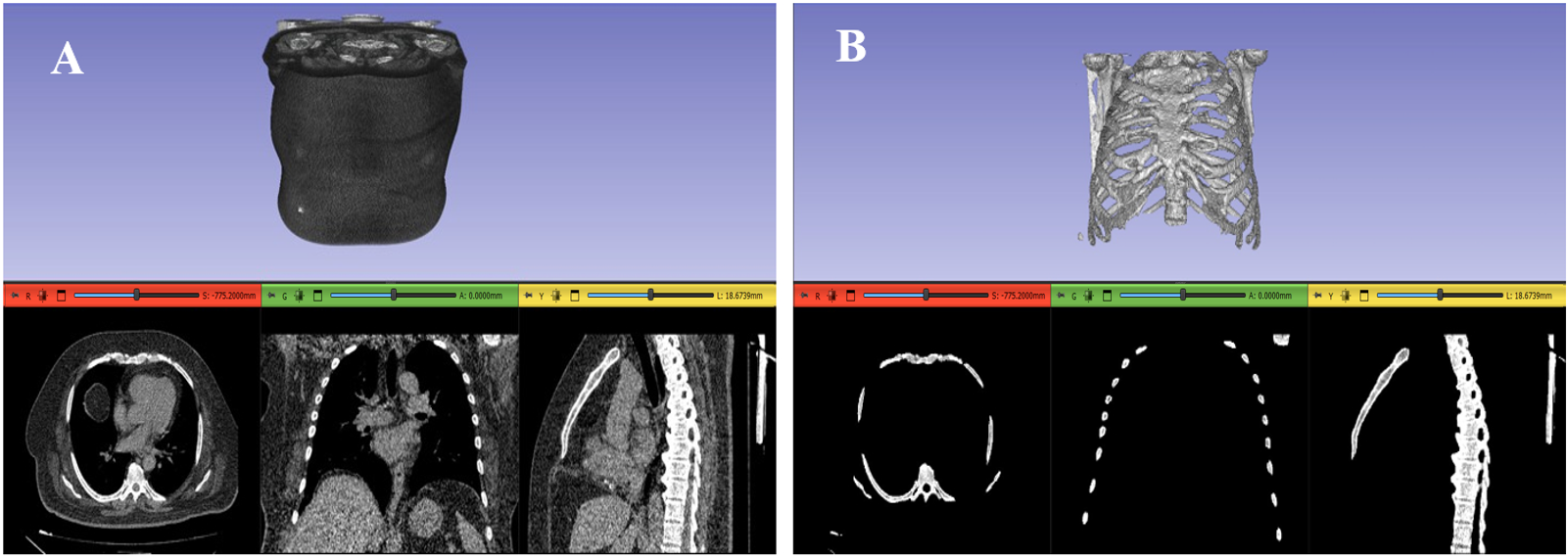 3D Medical Image Segmentation with 3D Modelling