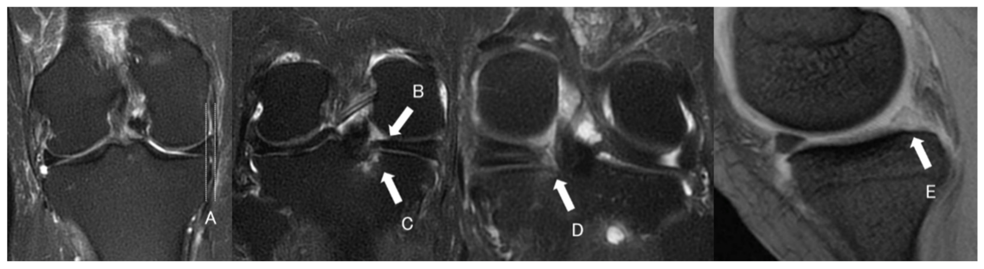 Time-Dependent Anchor Hole Expansion May Associate with Meniscal ...