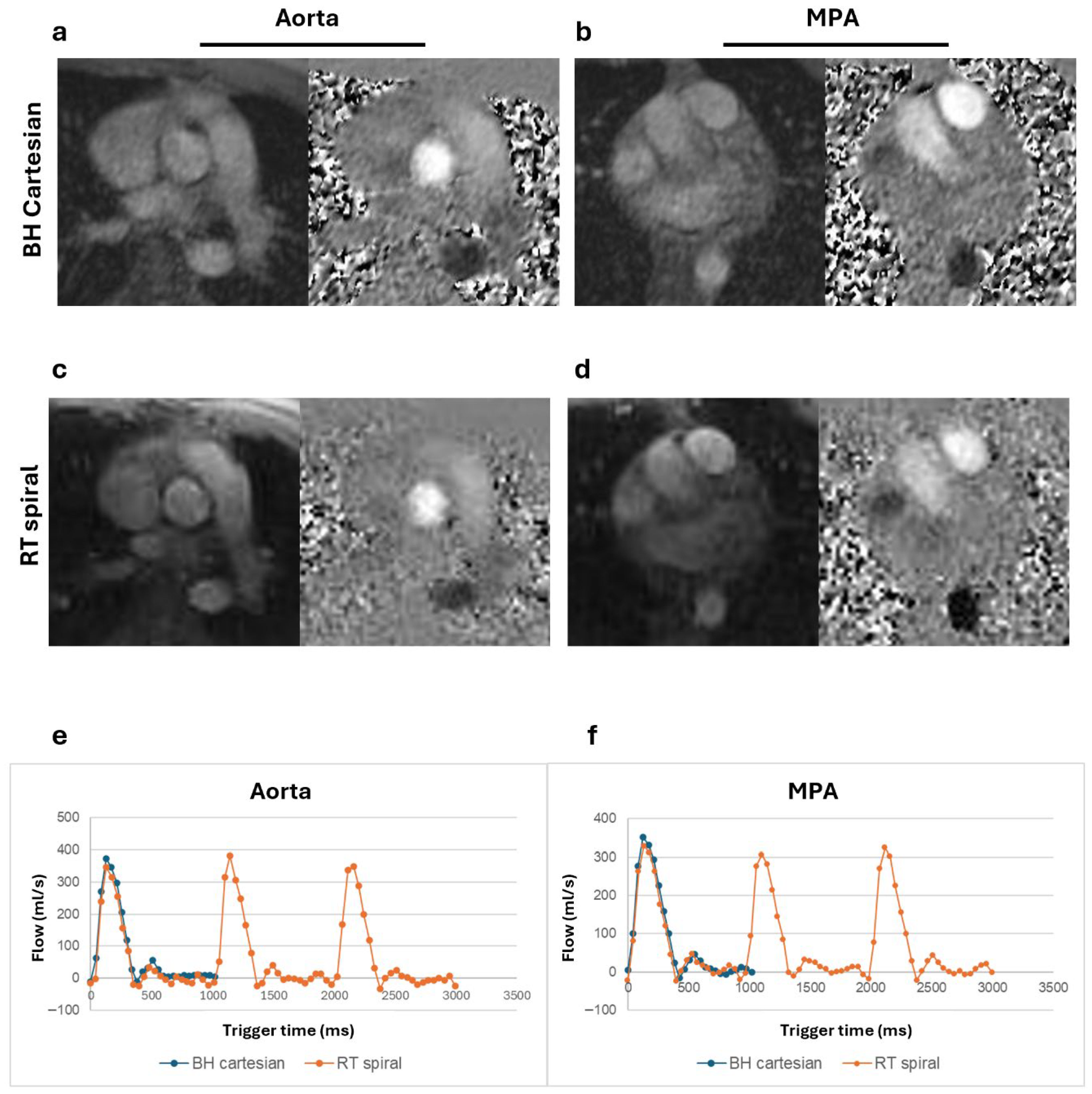 Feasibility of Golden Angle Spiral Real-Time Phase Contrast MRI at 0 ...