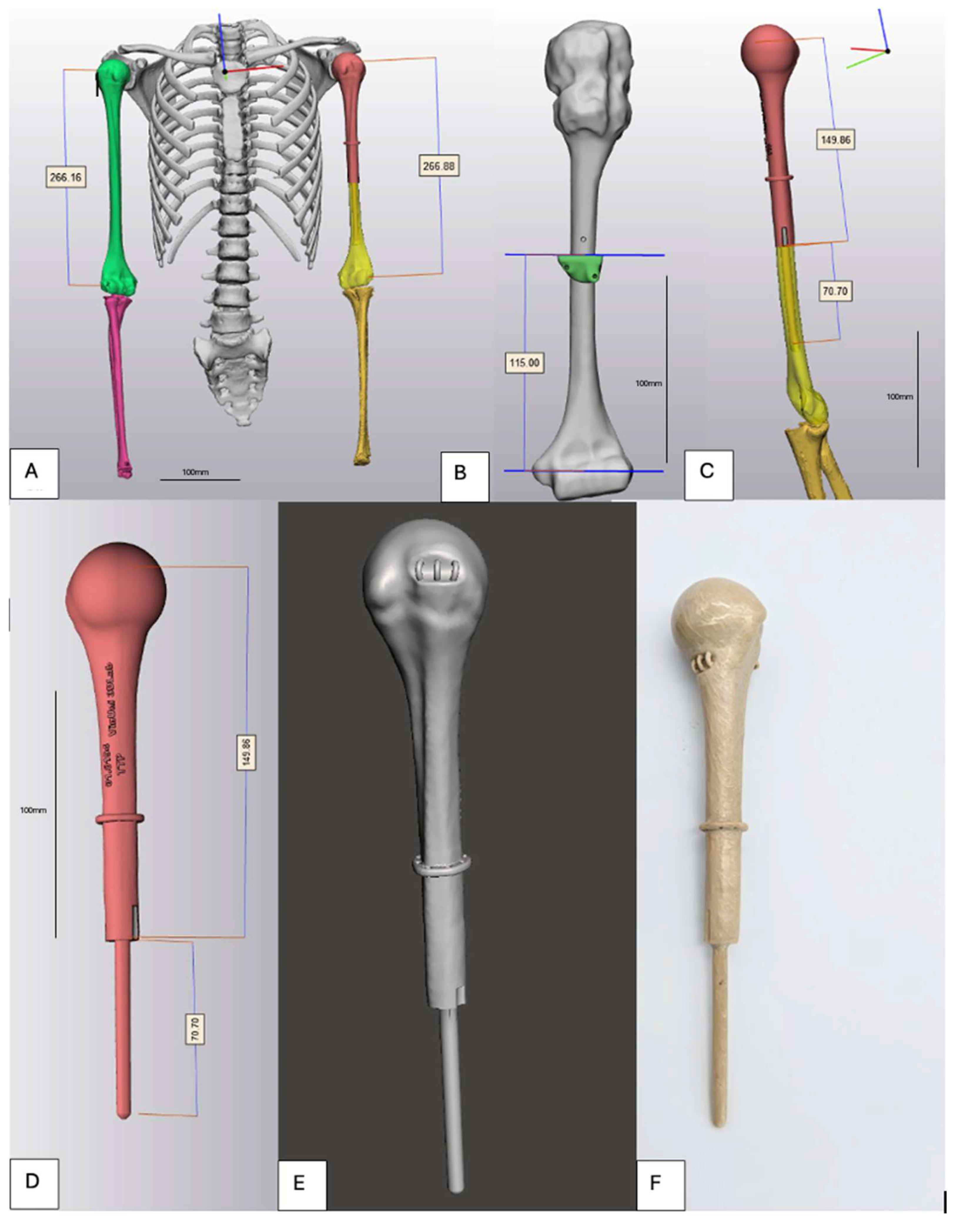 Limb-Salvage Reconstruction of the Proximal Humerus Using Patient ...