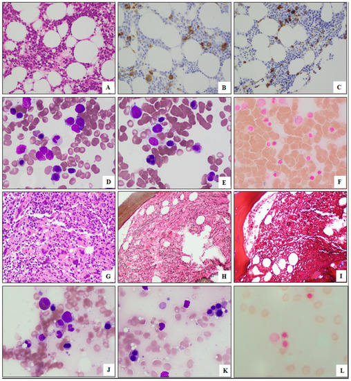 Concurrent Mutations in SF3B1 and PHF6 in Myeloid Neoplasms