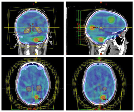 The First Survival Score for Patients Treated with Whole-Brain ...