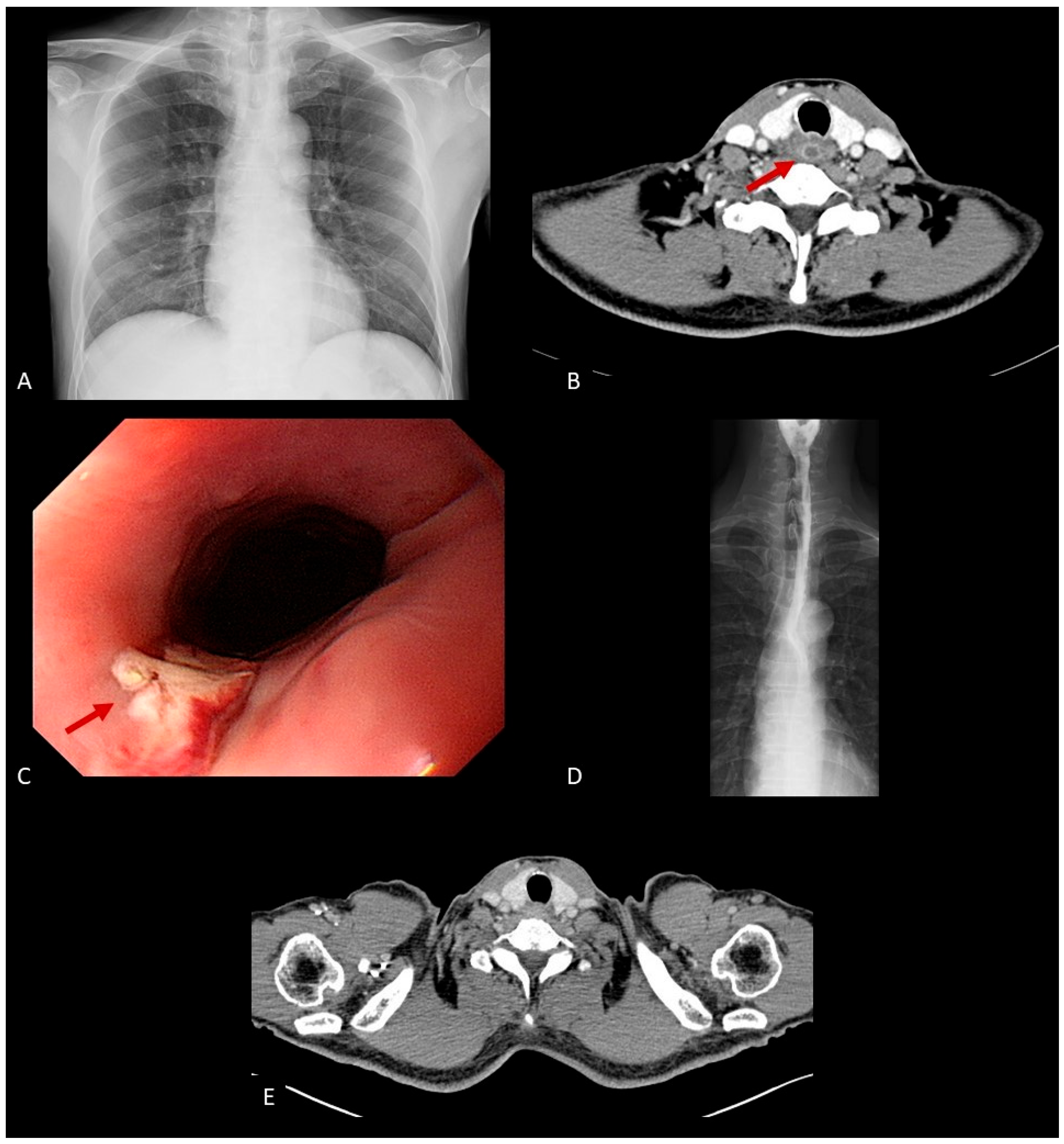 Esophageal Abscess Following Suspected Fish Bone Impaction: A Case ...