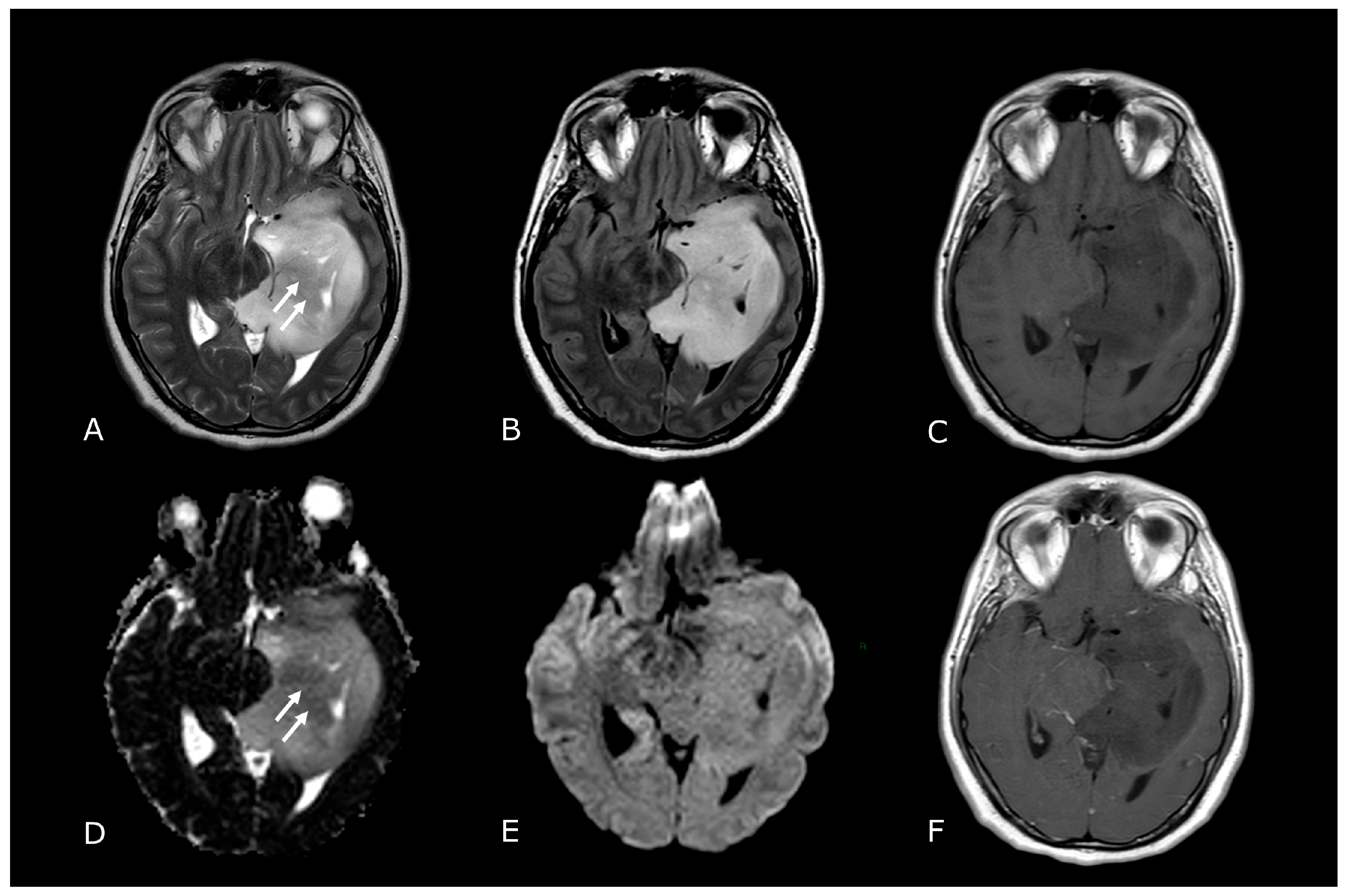 Magnetic Resonance Imaging Of Primary Adult Brain Tumors State Of The Magnetic Resonance Imaging Of Primary Adult Brain Tumors State Of The