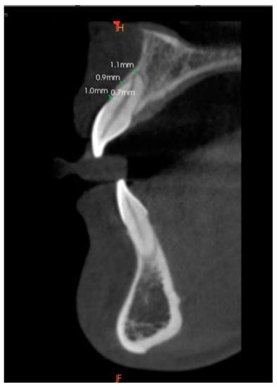 A CBCT Study of Labial Alveolar Bone Thickness in the Maxillary ...