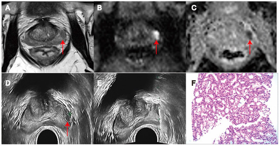 Biomedicines | Free Full-Text | Comparison of Targeted Biopsy and ...