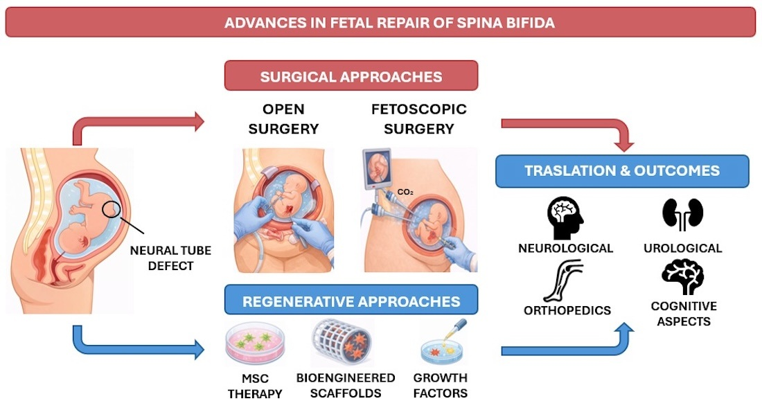Advances in Fetal Repair of Spina Bifida Integrating Prenatal Surgery ...
