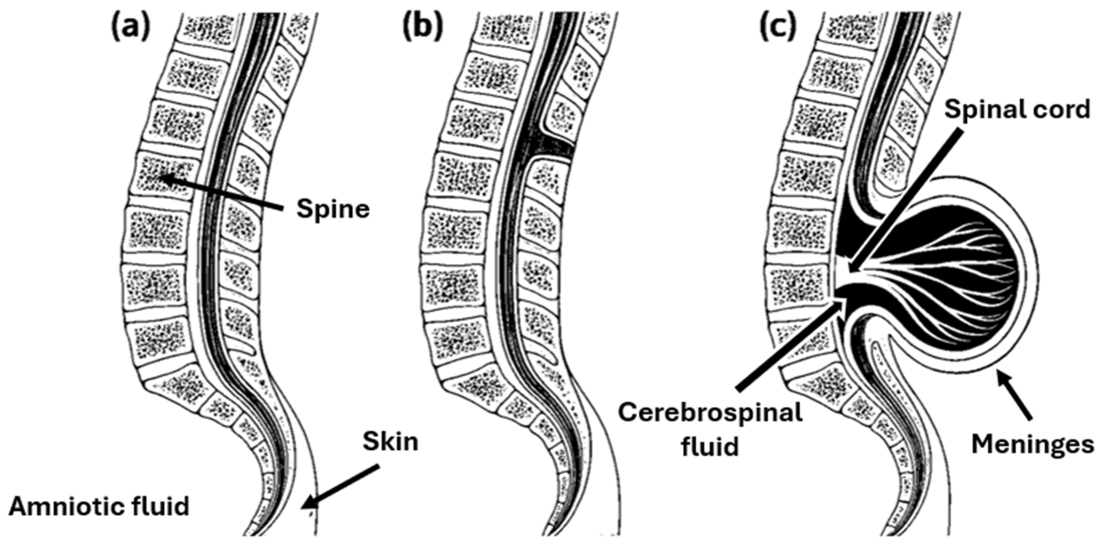 Advances in Fetal Repair of Spina Bifida Integrating Prenatal Surgery ...