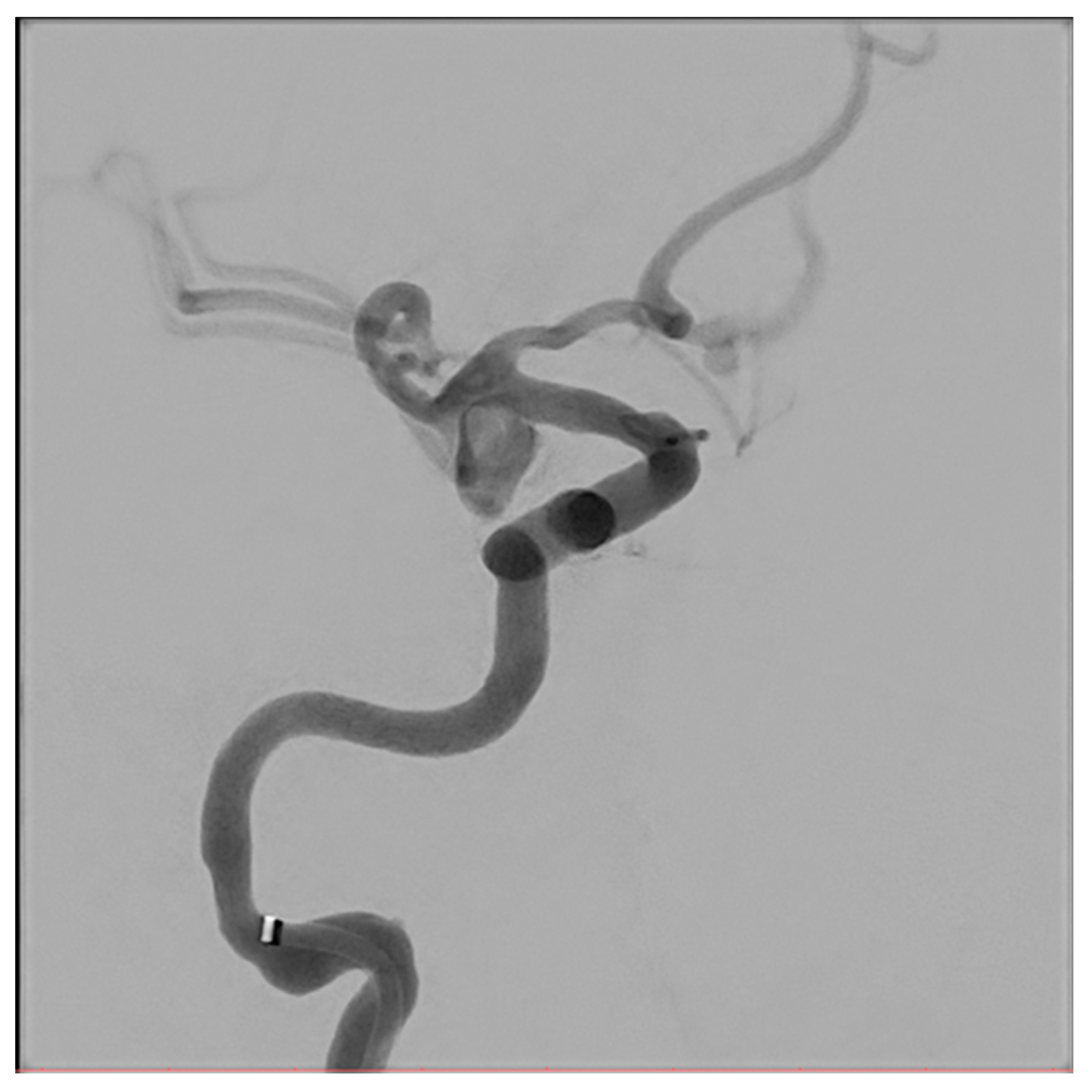 Local Diagnostic Reference Levels for Intracranial Aneurysm Coil-Only ...