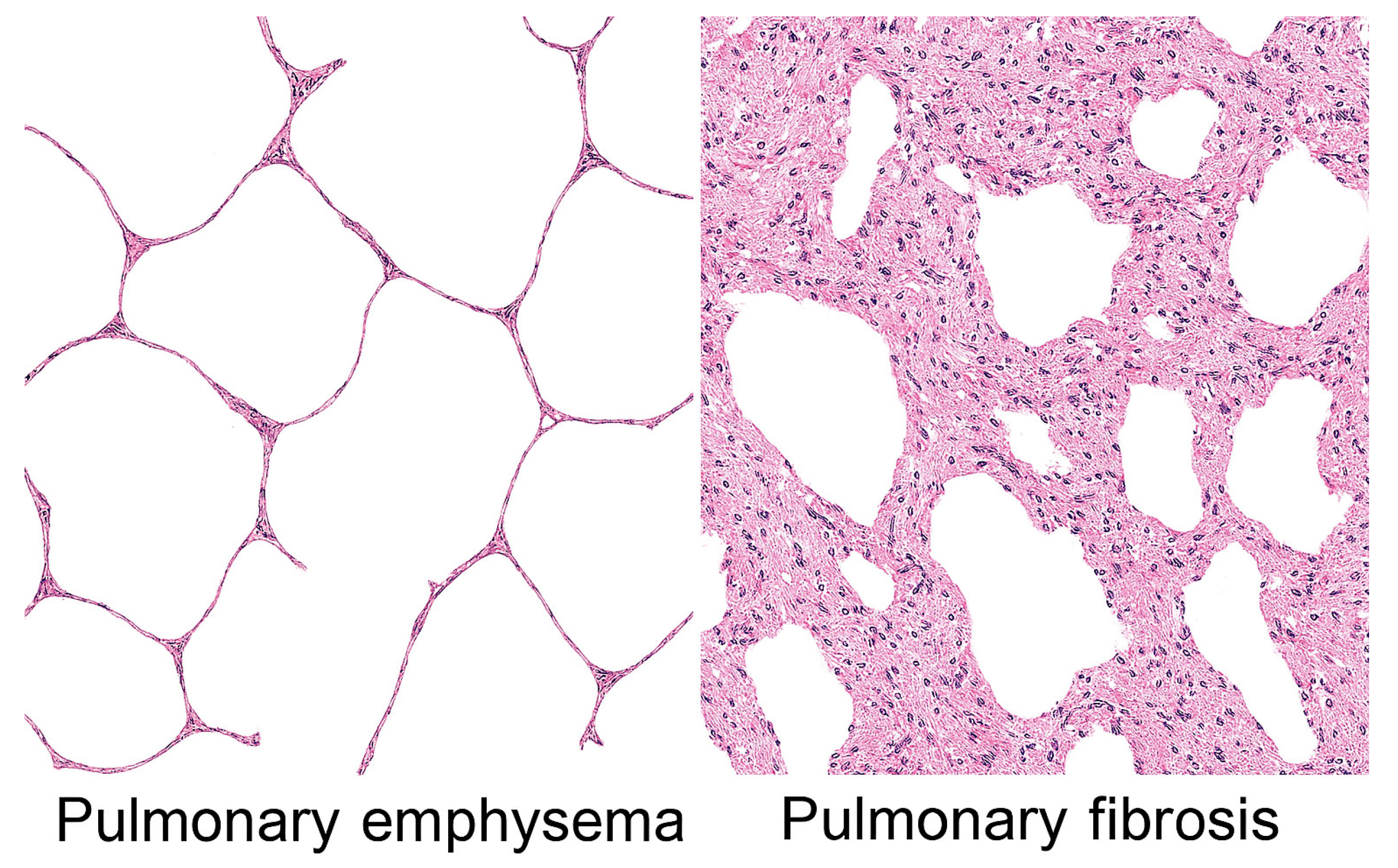 Percolation Forces in Lung Inflammation: Determining the Path to ...