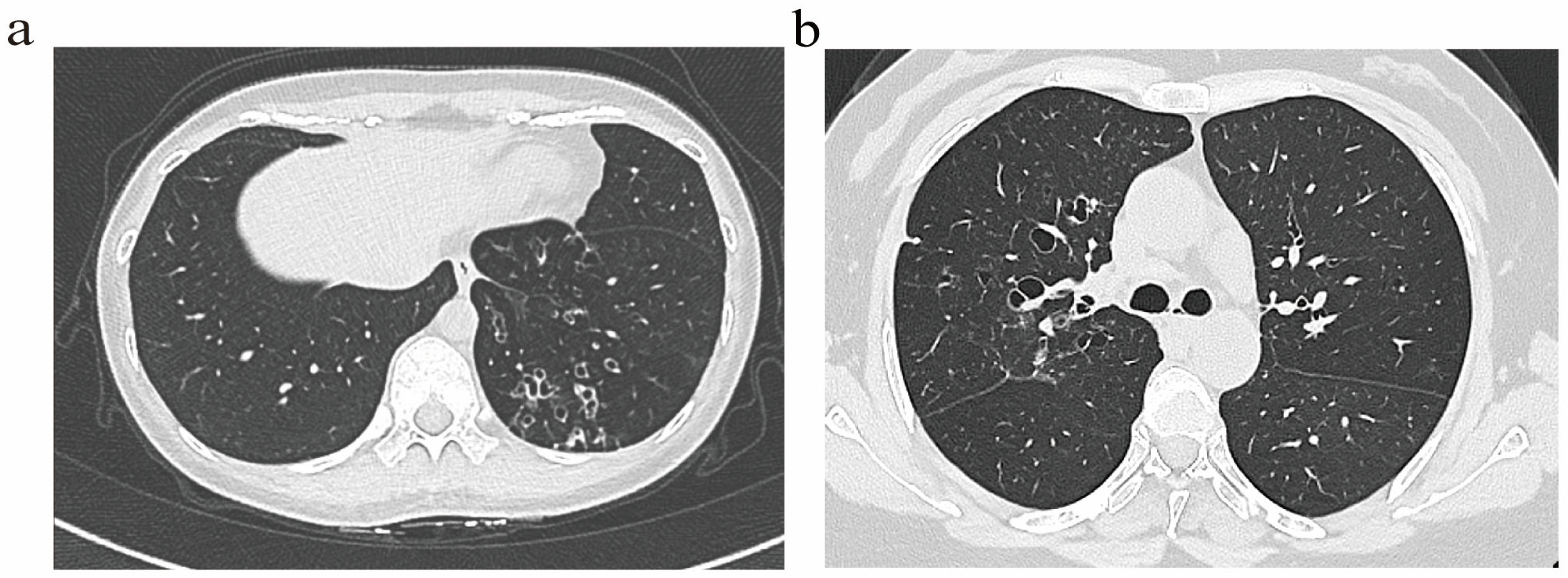 Radiological Phenotypes of Bronchiectasis Based on Airway Generation