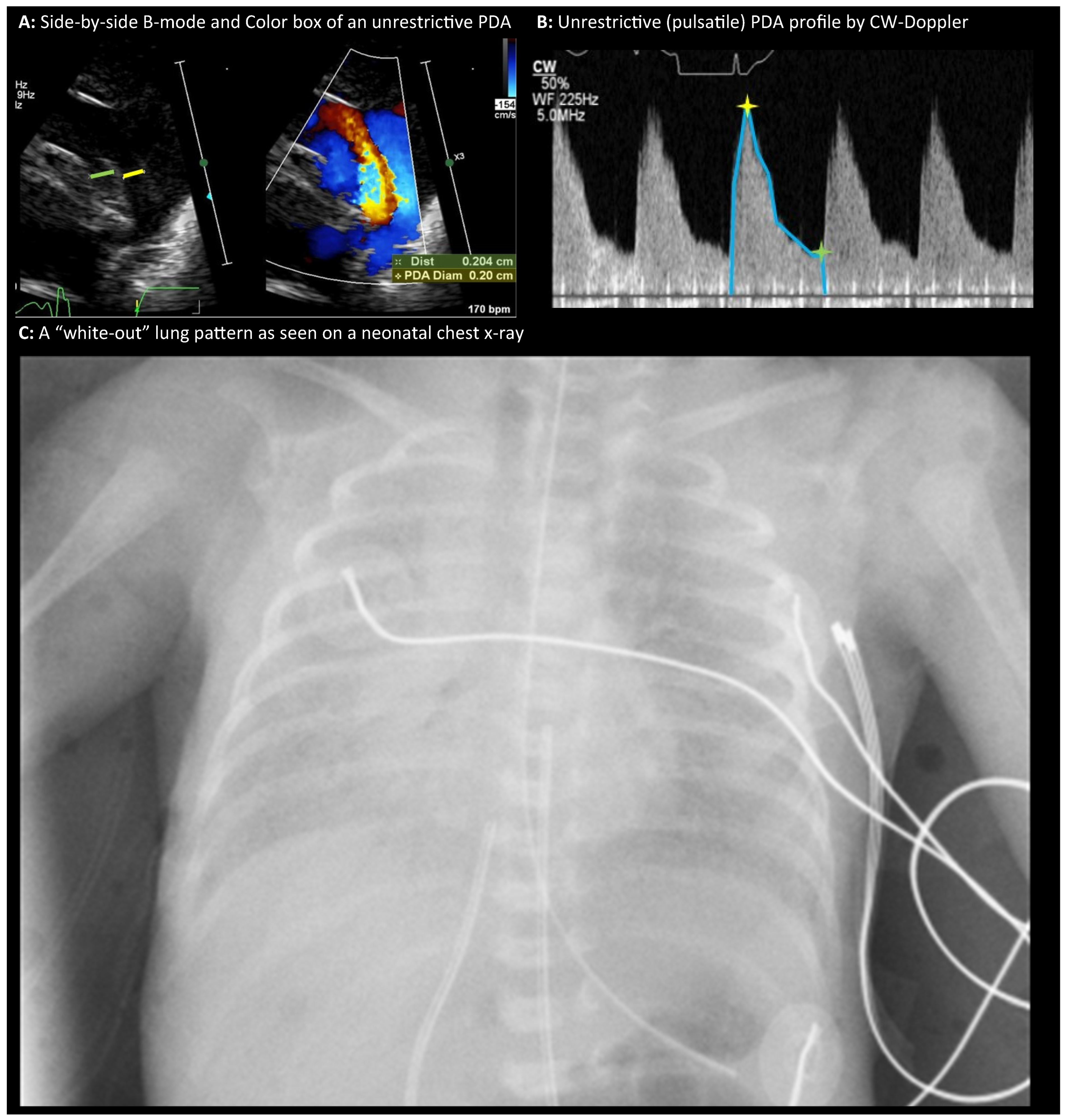 PDA in Prematurity: Rethinking a Decades-Old Debate in 2026