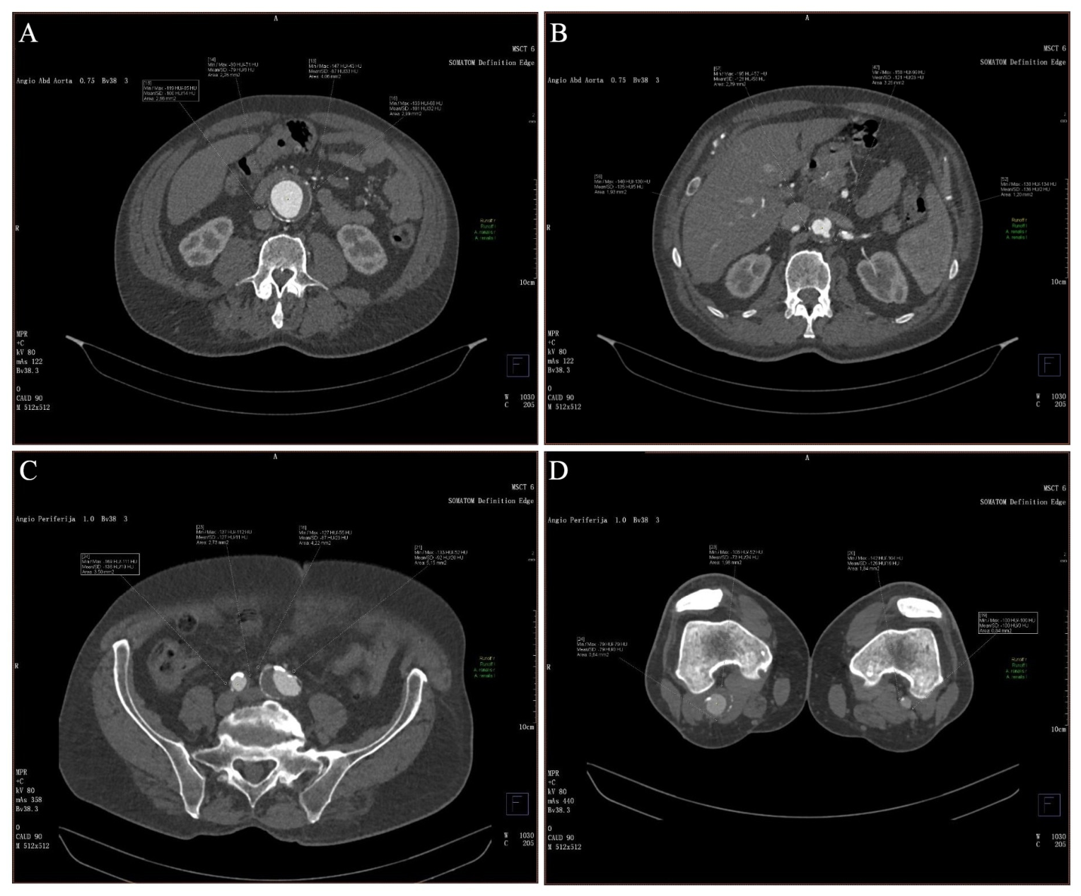 MSCT Assessment of Perivascular Adipose Tissue and Visceral Fat ...