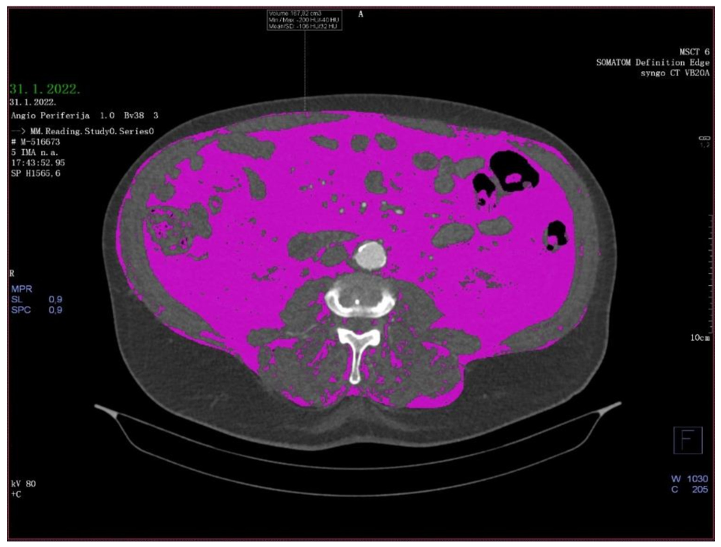 MSCT Assessment of Perivascular Adipose Tissue and Visceral Fat ...
