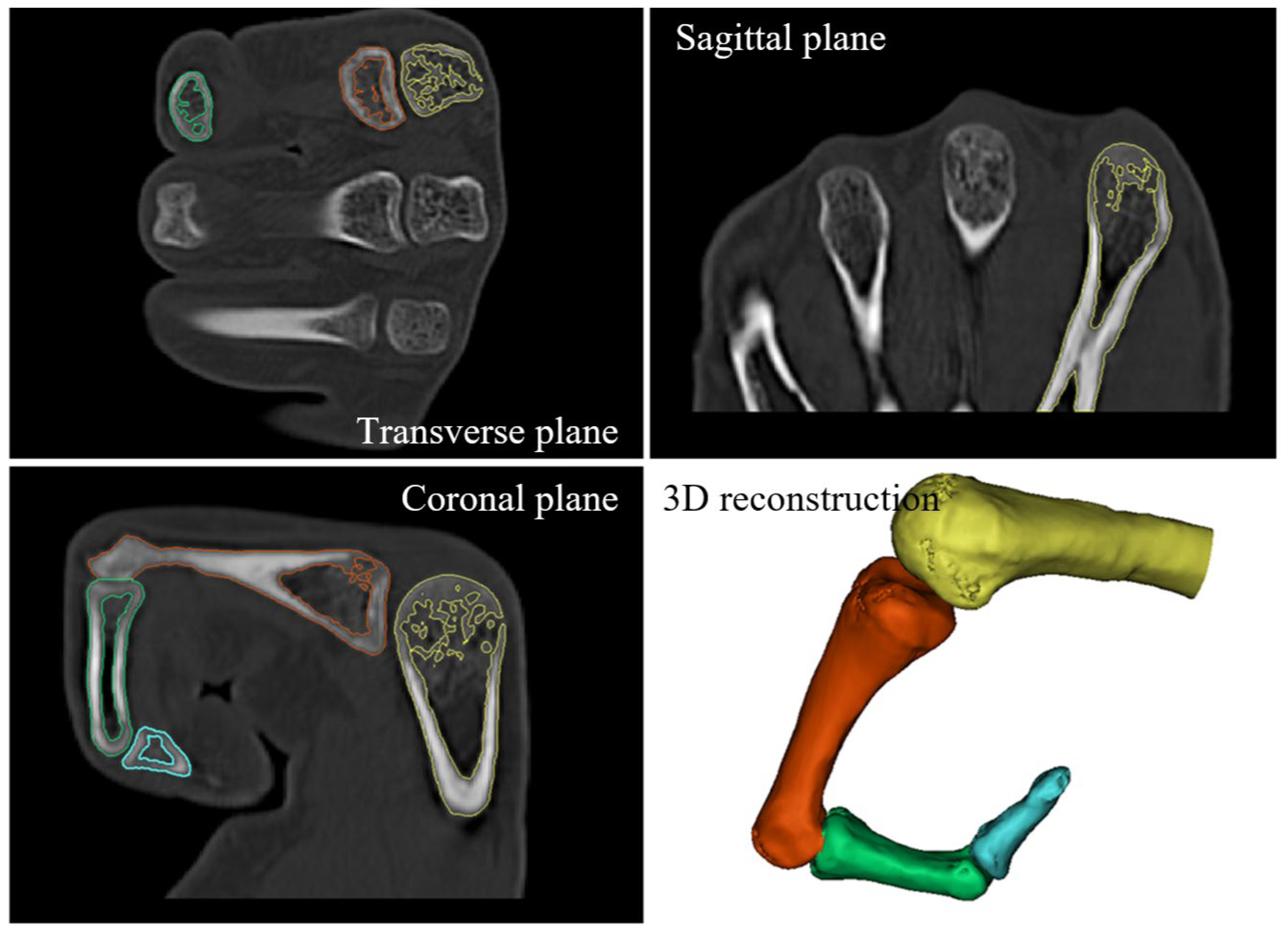 Medical Imaging-Based Kinematic Modeling for Biomimetic Finger Joints and Hand Exoskeleton ...