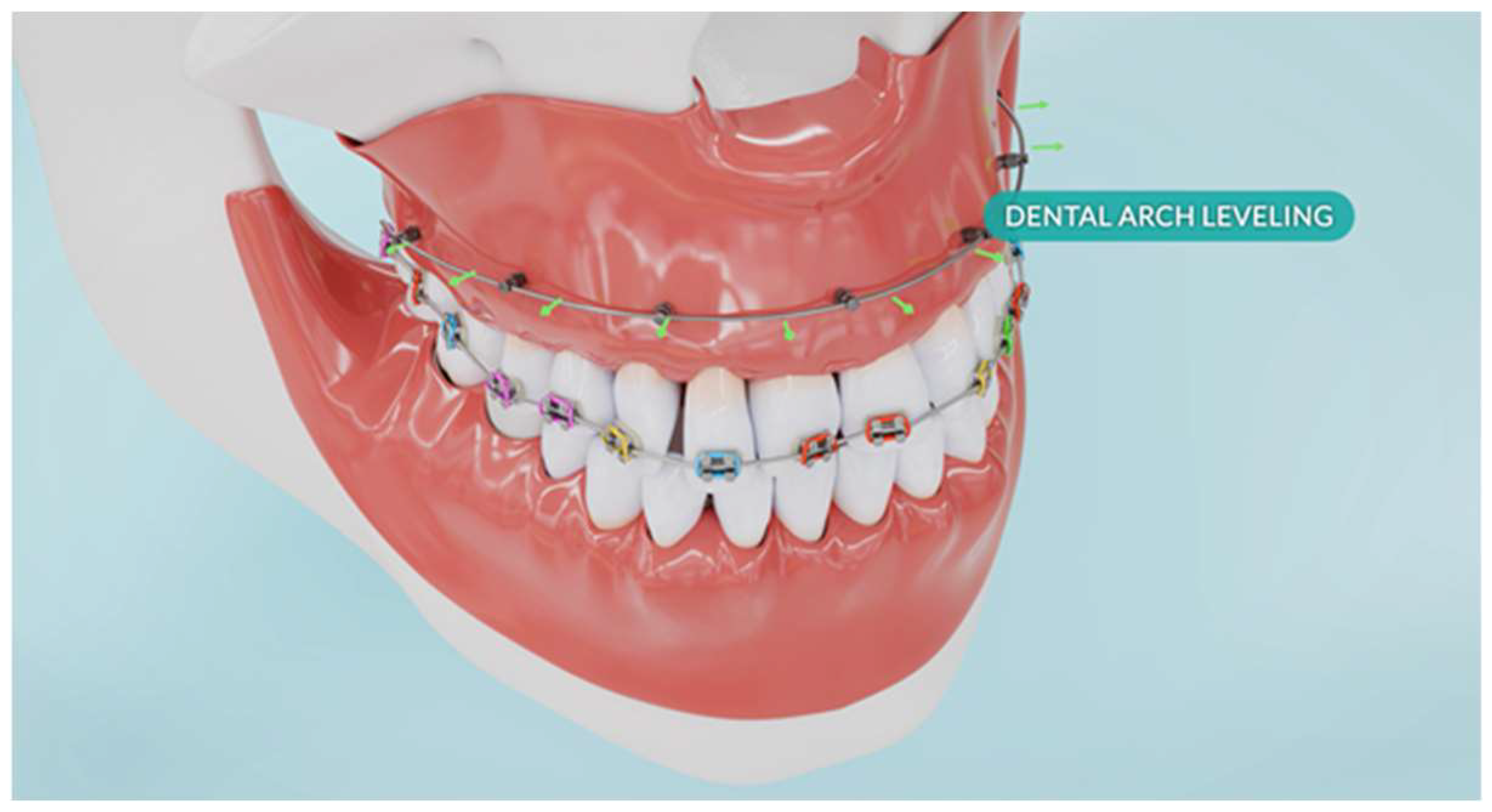 Mechanobiological Regulation of Alveolar Bone Remodeling: A Finite ...