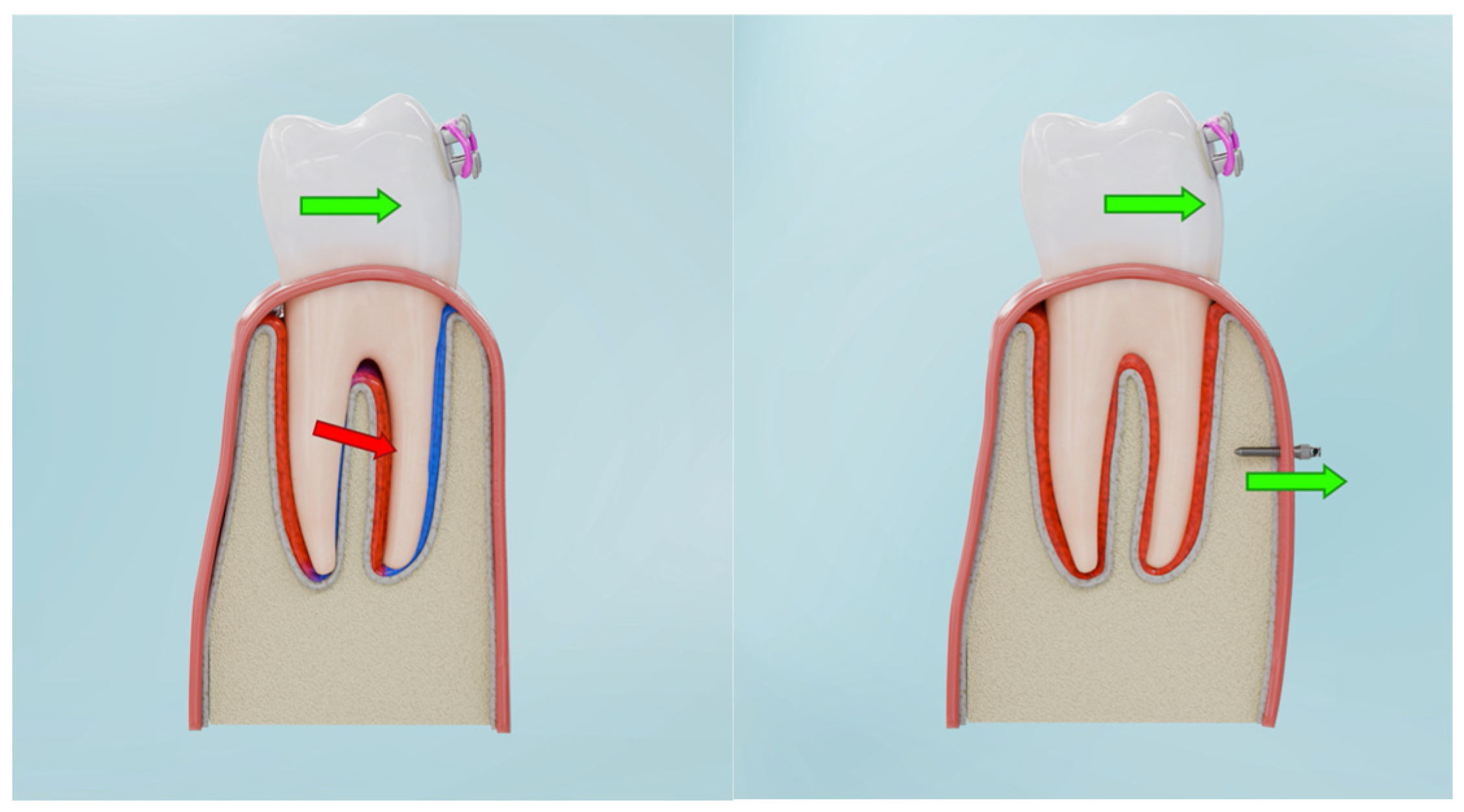 Mechanobiological Regulation of Alveolar Bone Remodeling: A Finite ...