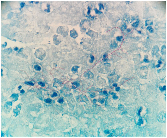 Nocardia farcinica Brain Abscess in a Multiple Myeloma Patient Treated ...