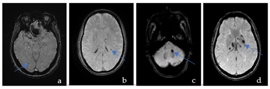 Analysis of Risk Factors for Cerebral Microbleeds and the Relationship ...