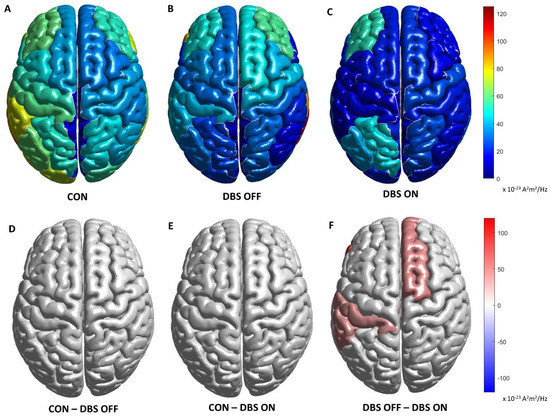STN-DBS Induces Acute Changes in β-Band Cortical Functional Connectivity in Patients with ...