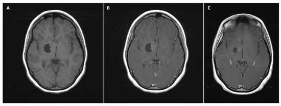 Surgical Treatment of Pediatric Incidentally Found Brain Tumors: A ...