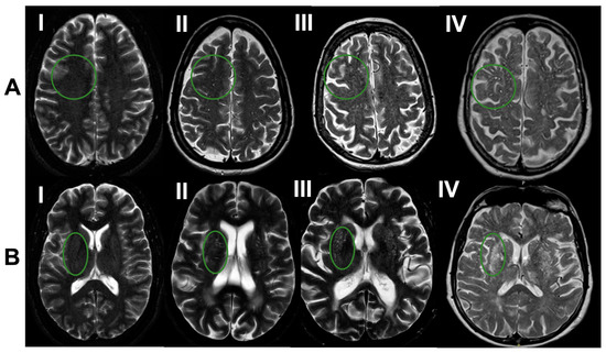 Relation of MRI-Visible Perivascular Spaces and Other MRI Markers of ...