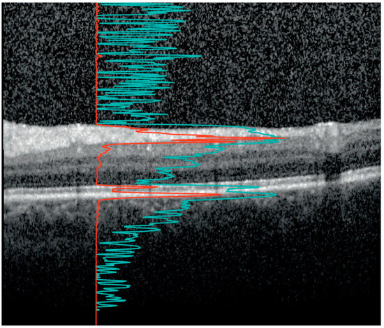 Exploring Vitreous Haze as a Potential Biomarker for Accelerated ...