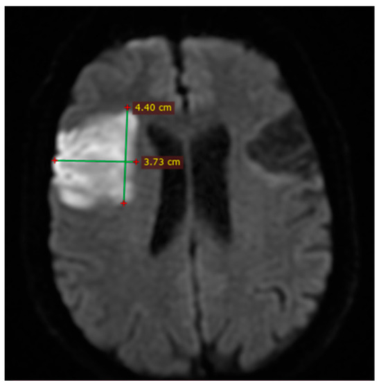 Correlation between DWI-ASPECTS Score, Ischemic Stroke Volume on DWI ...