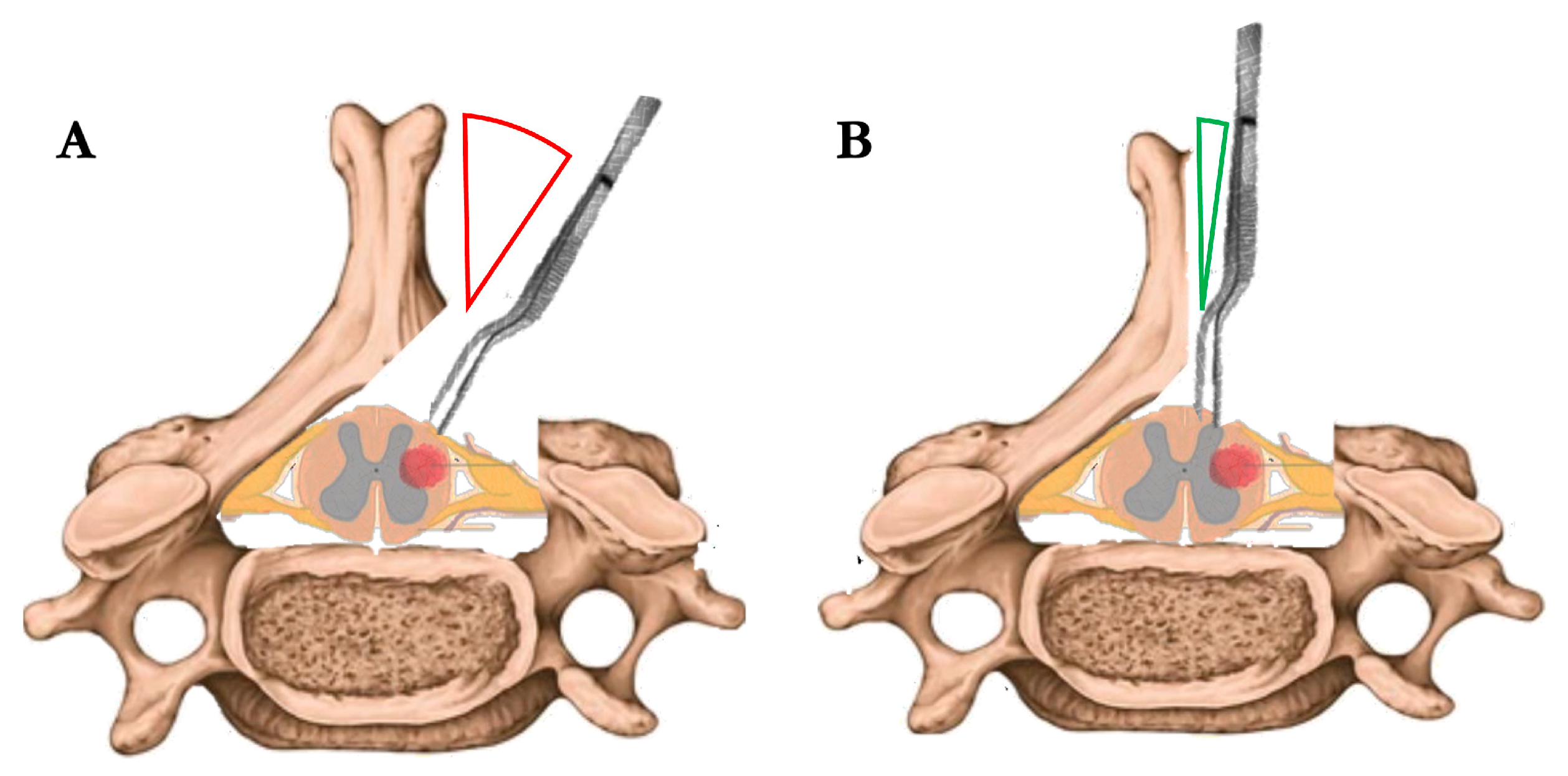 Modified Hemilaminectomy for Bilateral Exposure in Intramedullary ...