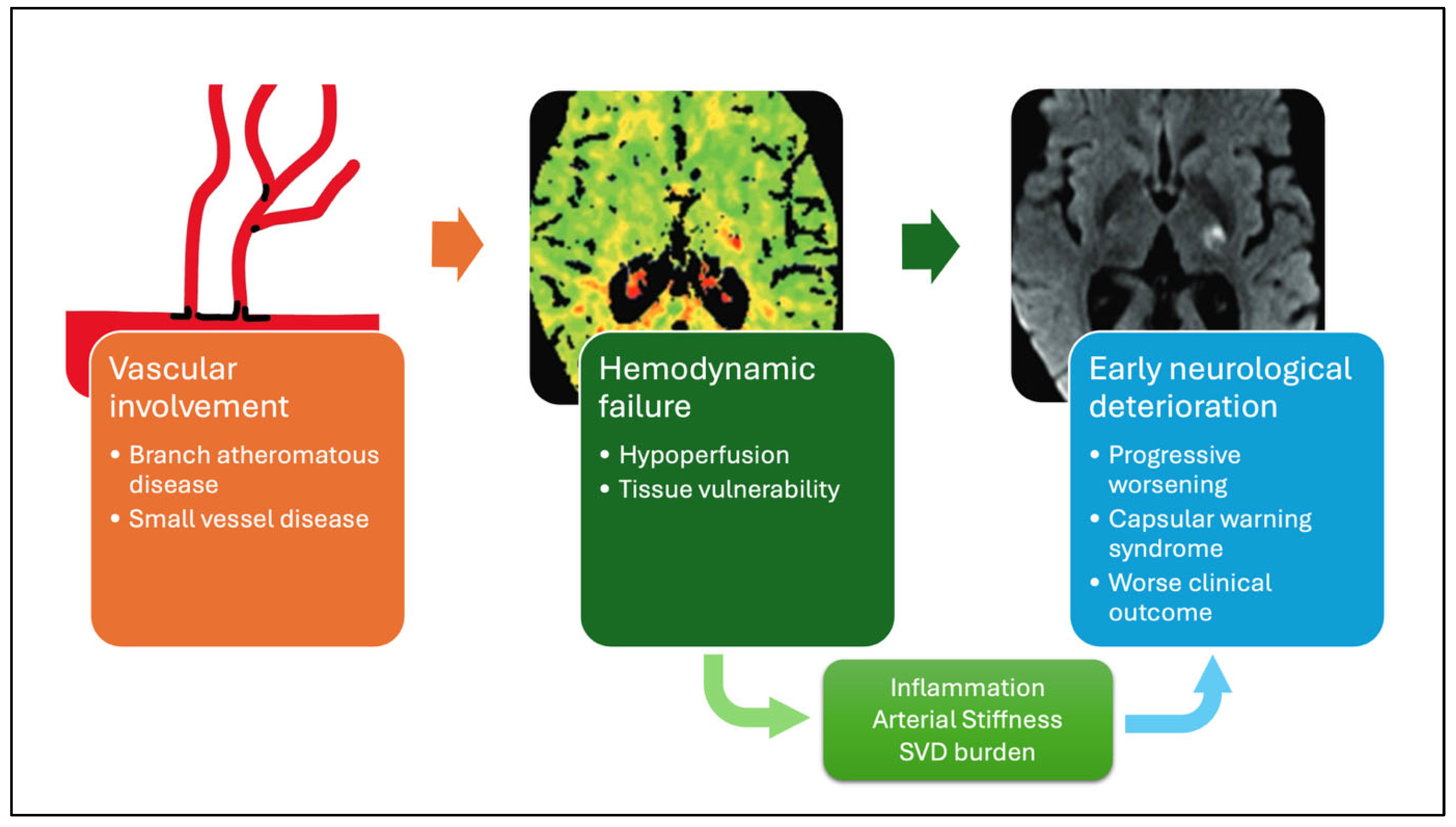 Early Neurological Deterioration in Subcortical Infarcts: A Narrative ...