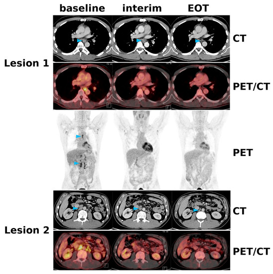 Cancers | Free Full-Text | RECIL Versus Lugano for Treatment Response ...