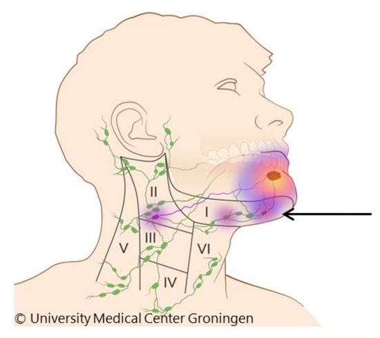 Lymph Nodes In Neck Cancer