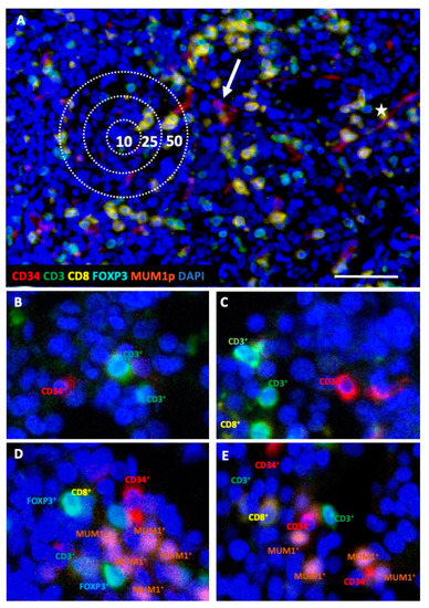 Altered Spatial Composition of the Immune Cell Repertoire in ...