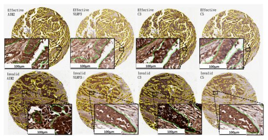 A Weakly Supervised Deep Learning Method for Guiding Ovarian Cancer ...