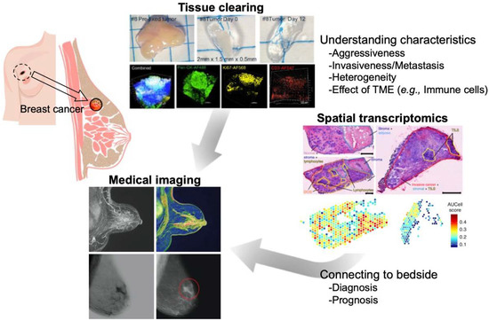Understanding Breast Cancers through Spatial and High-Resolution ...