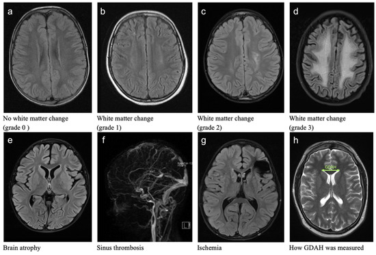 Cranial MRI in Childhood Acute Leukemia during Treatment and Follow-Up ...