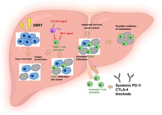 Stereotactic Body Radiation Therapy (SBRT) Plus Immune Checkpoint ...