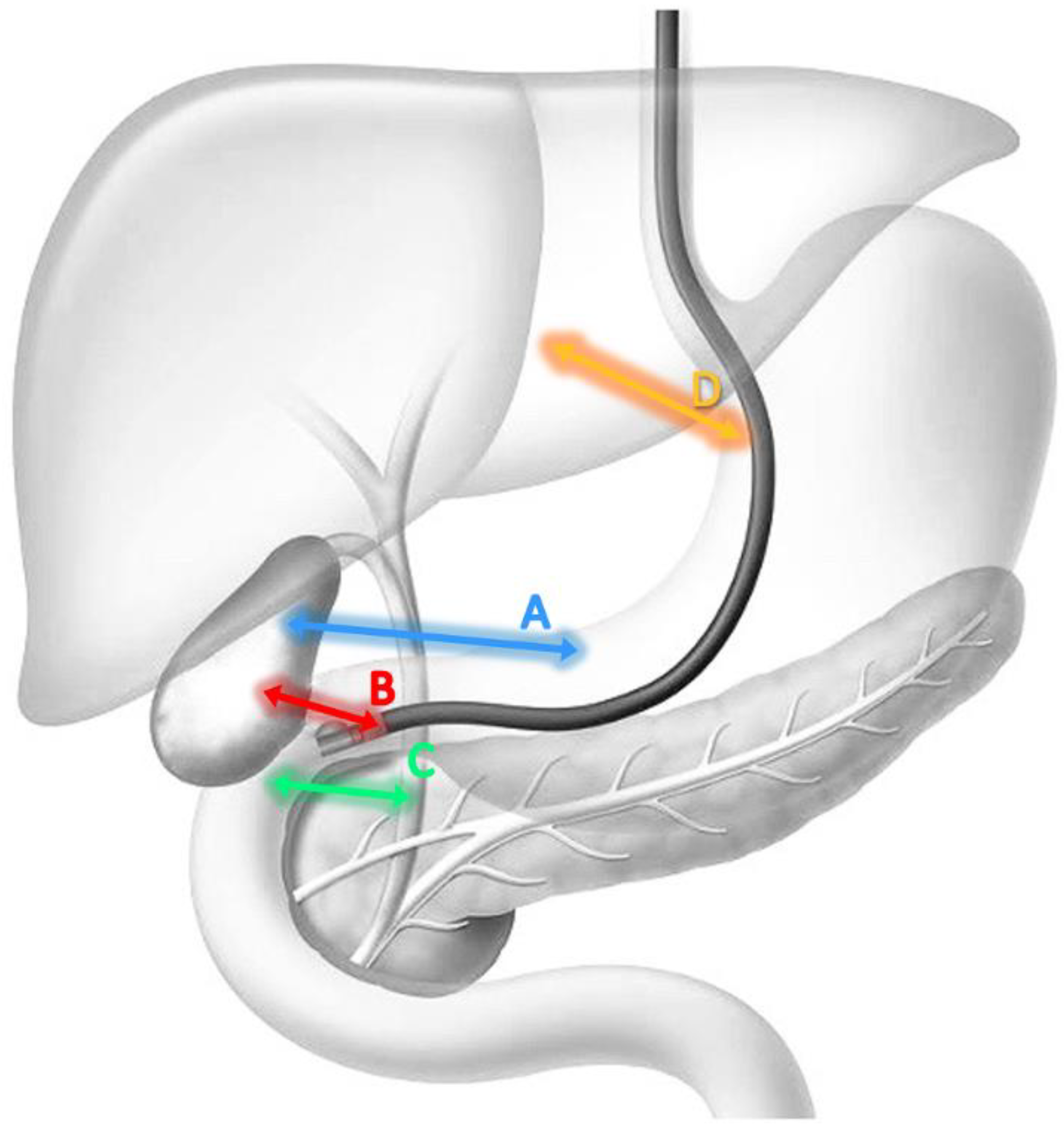 Endoscopic Ultrasound Guided Biliary Drainage In Malignant Distal Endoscopic Ultrasound Guided Biliary Drainage In Malignant Distal