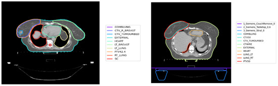 Standardising Breast Radiotherapy Structure Naming Conventions: A ...