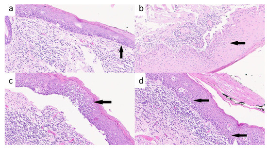 The Genetic and Immunologic Landscape Underlying the Risk of Malignant ...