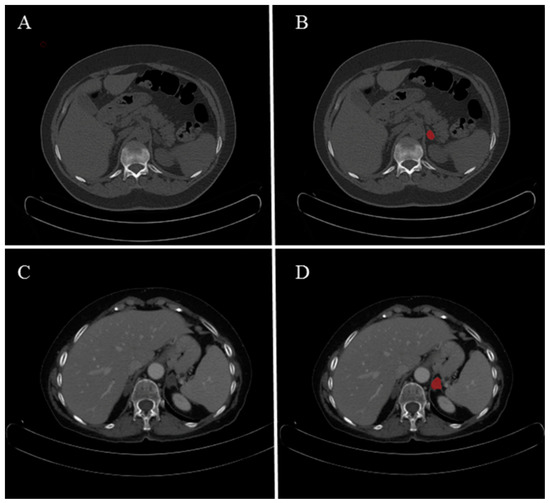 Prediction of 2-[18F]FDG PET-CT SUVmax for Adrenal Mass Characterization: A CT Radiomics ...
