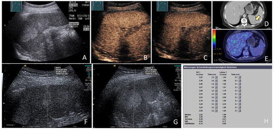Acoustic Radiation Force Impulse (ARFI) Elastography of Focal Splenic ...