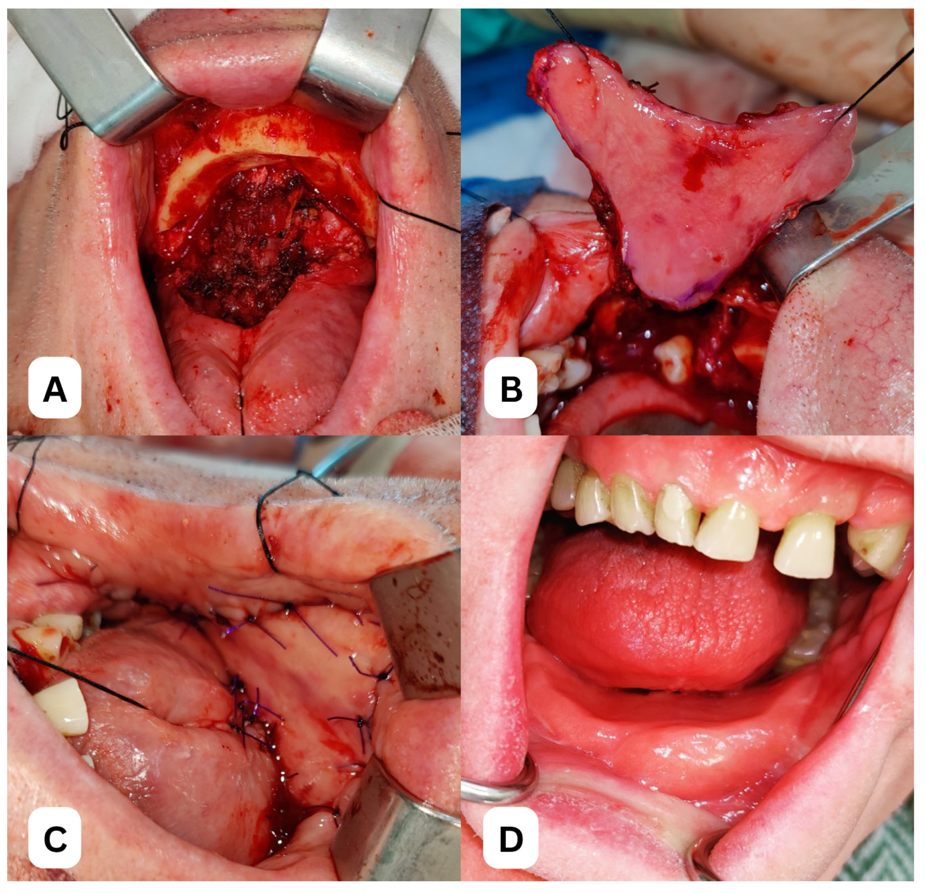 Reconstruction of the Oral Cavity Using Facial Vessel-Based Flaps—A ...