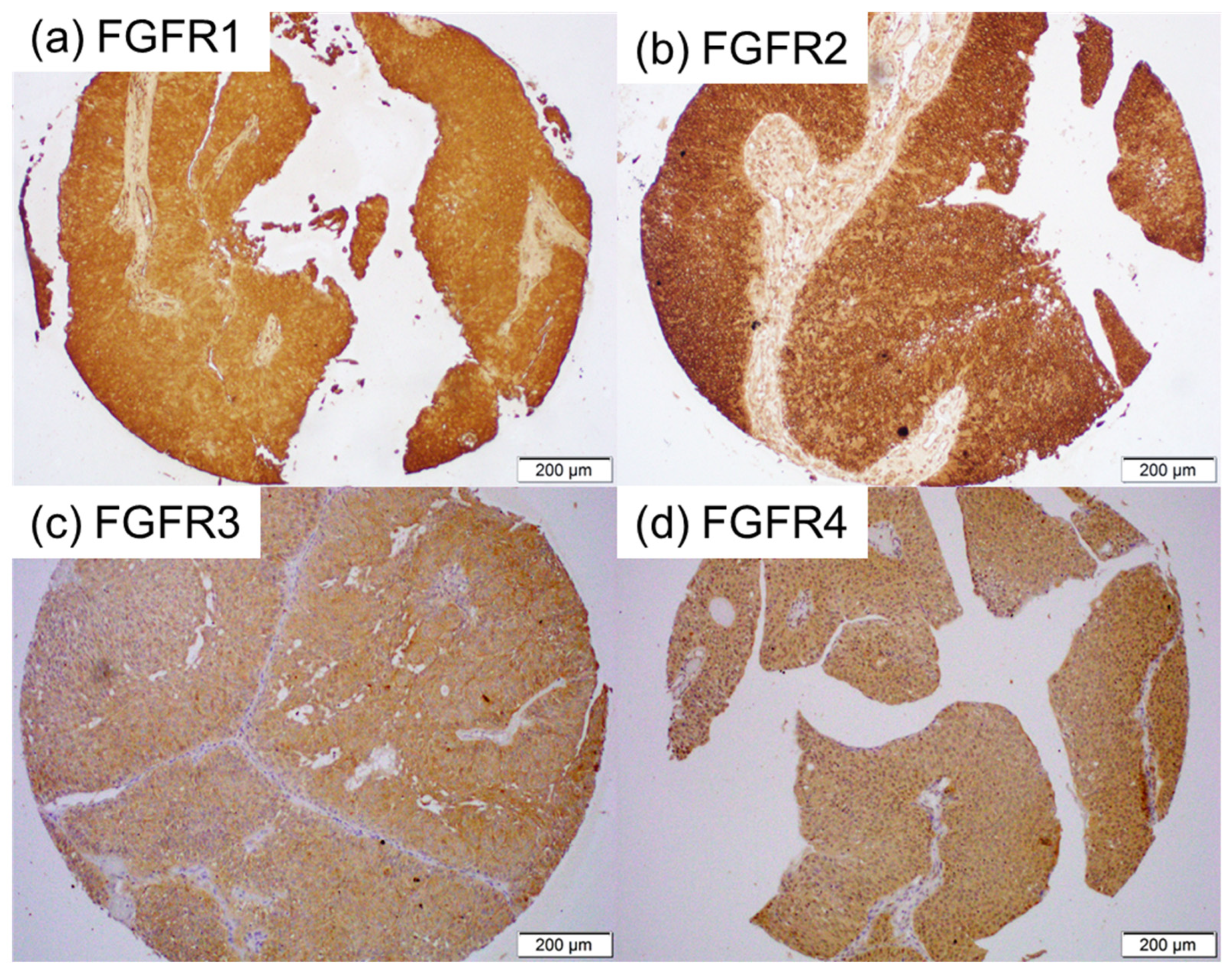 The Role of FGFR3 in the Progression of Bladder Cancer