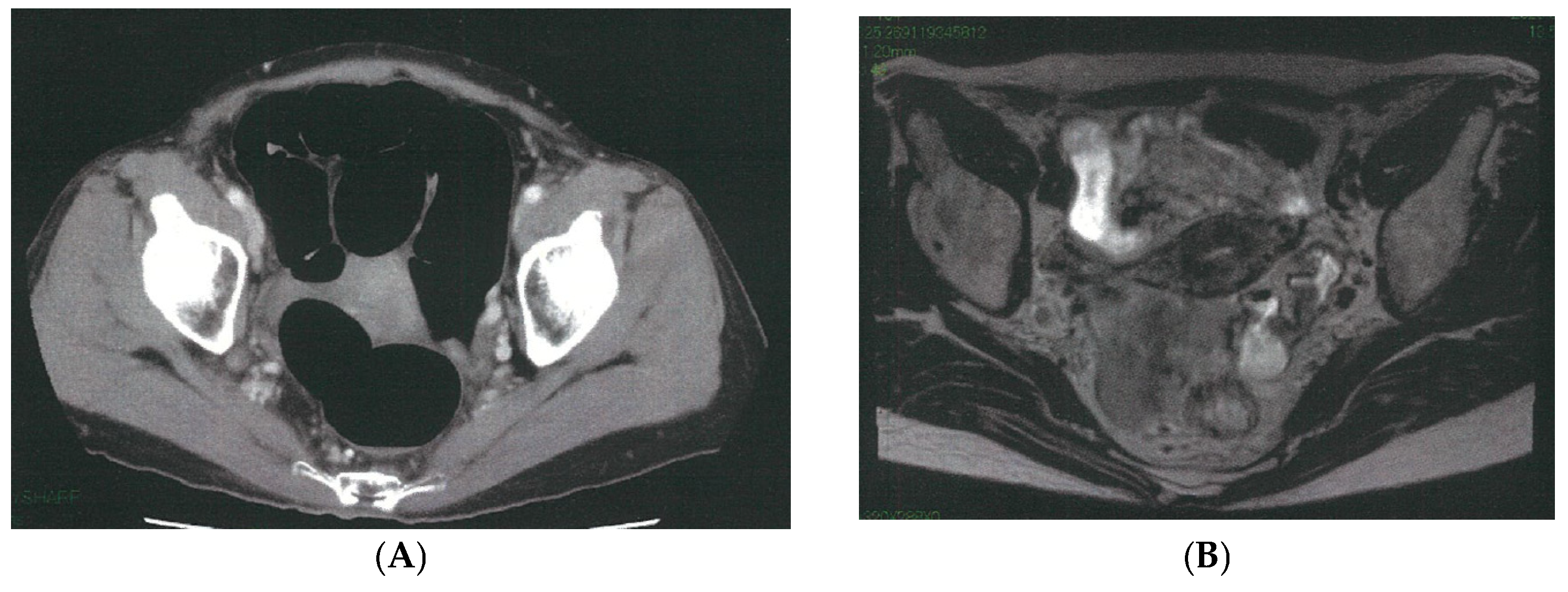 Robotic Lateral Pelvic Lymph Node Dissection for Advanced Rectal Cancer ...