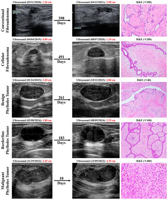 Tumor Growth Rate Predicts Pathological Outcomes in Breast ...