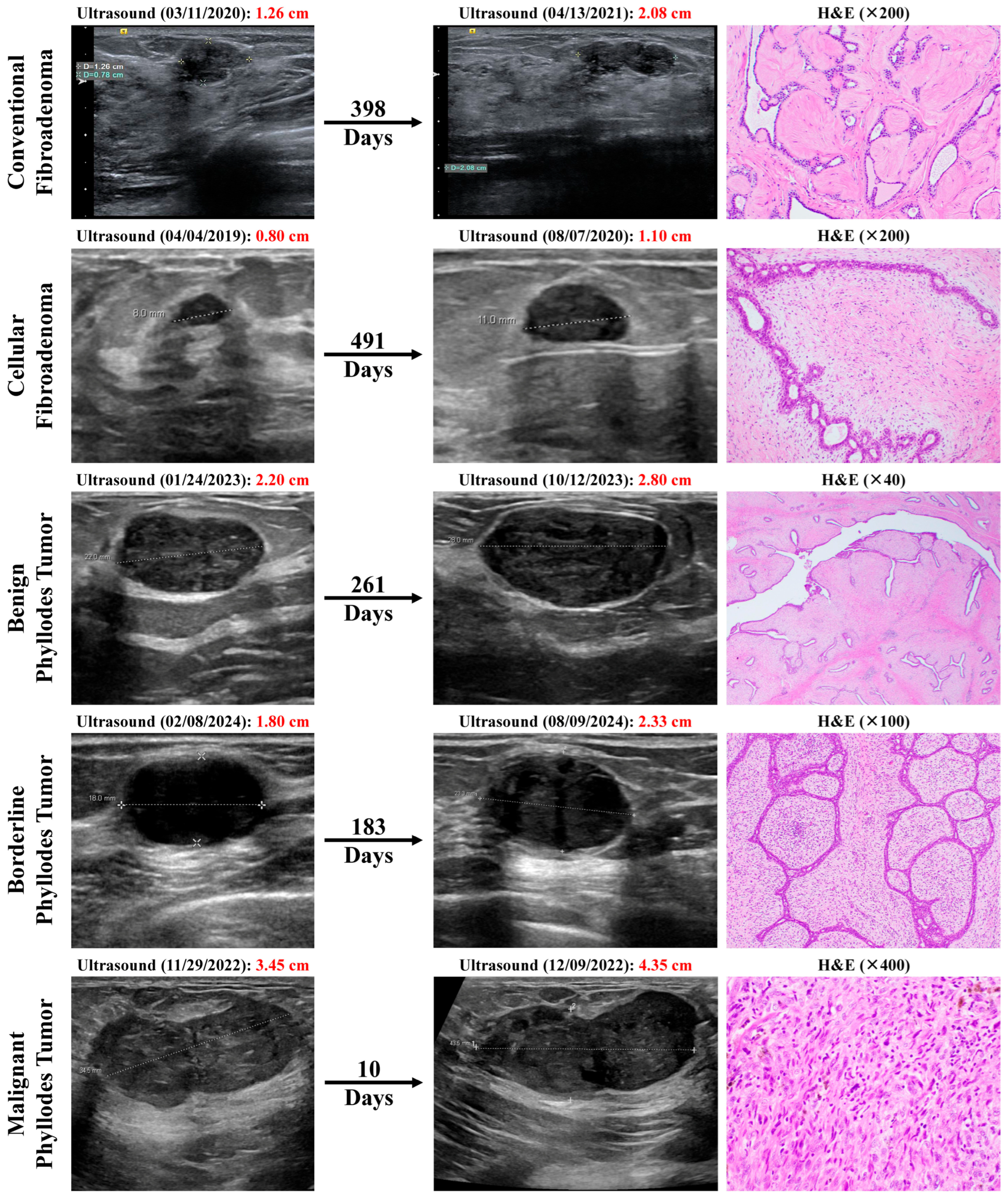 Tumor Growth Rate Predicts Pathological Outcomes in Breast ...