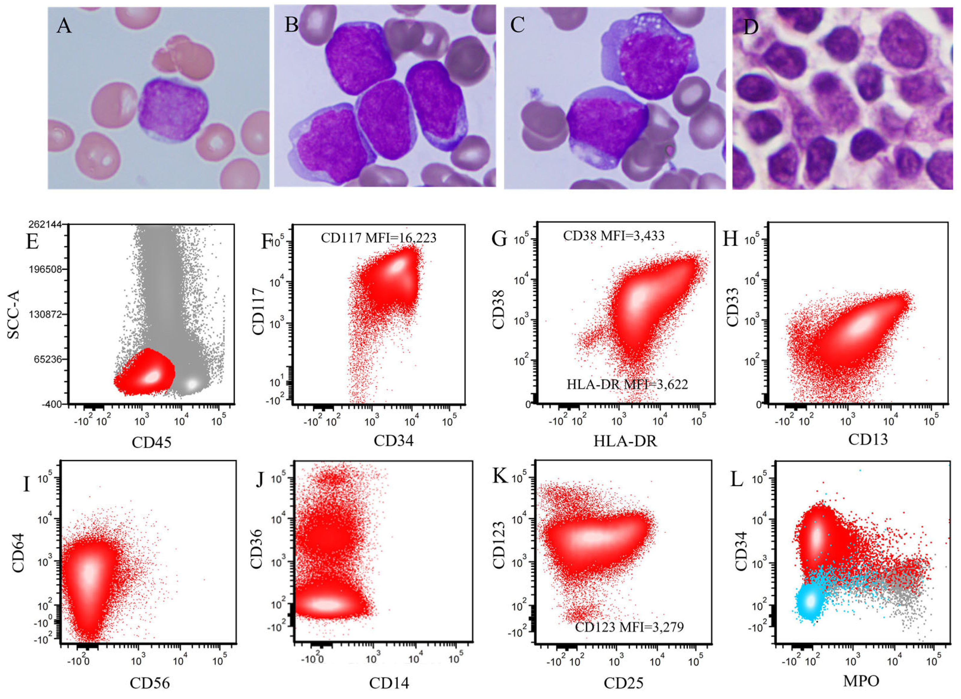 Aberrant CD25 and Increased CD123 Expression Are Common in Acute ...