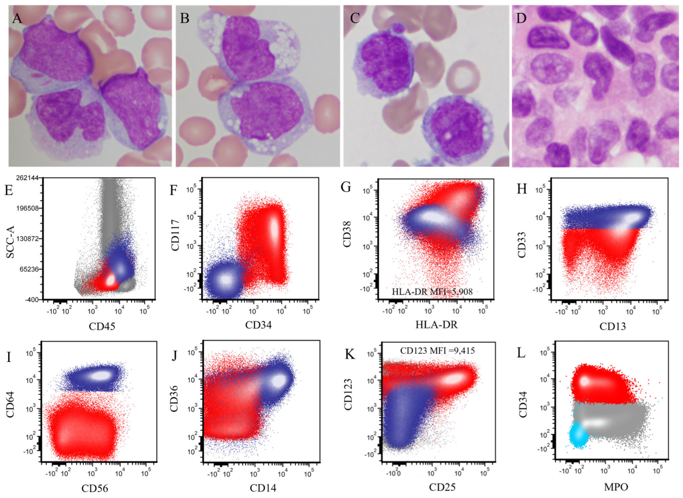 Aberrant CD25 and Increased CD123 Expression Are Common in Acute ...